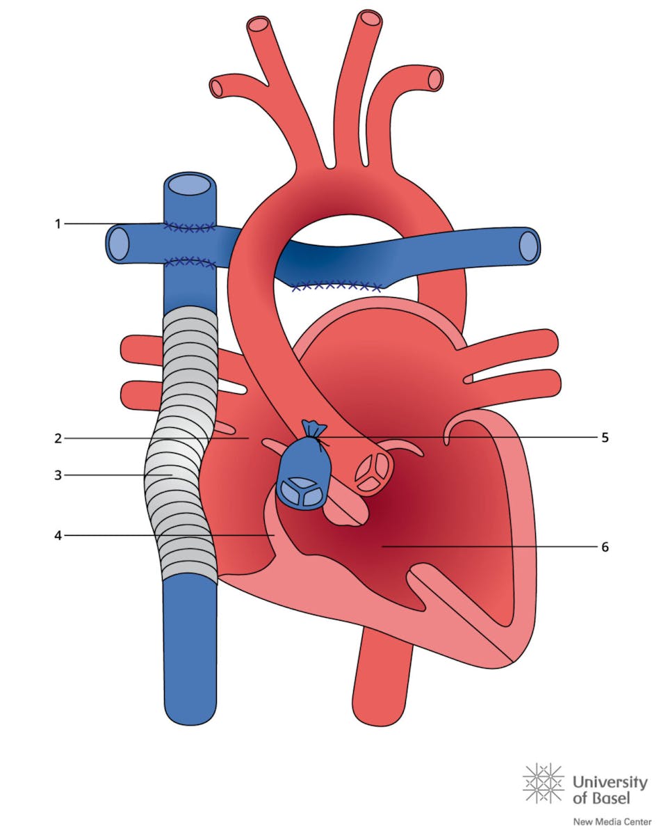 Hypoplastisch rechterhart syndroom (HRHS) | Stichting Hartekind